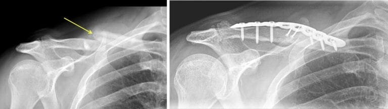 Fratura De Clavícula:3 Causas,Prevenção E Melhor Tratamento